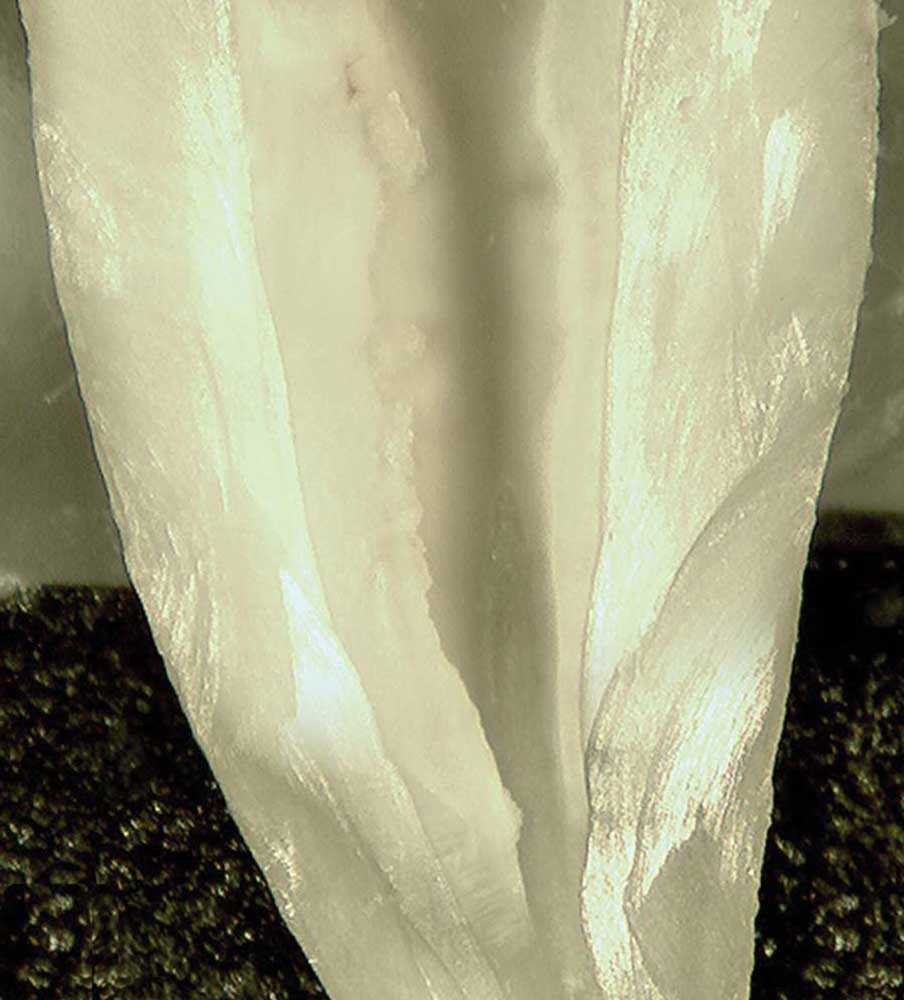 Root Canal Results Worth Talking About | GentleWave® Procedure