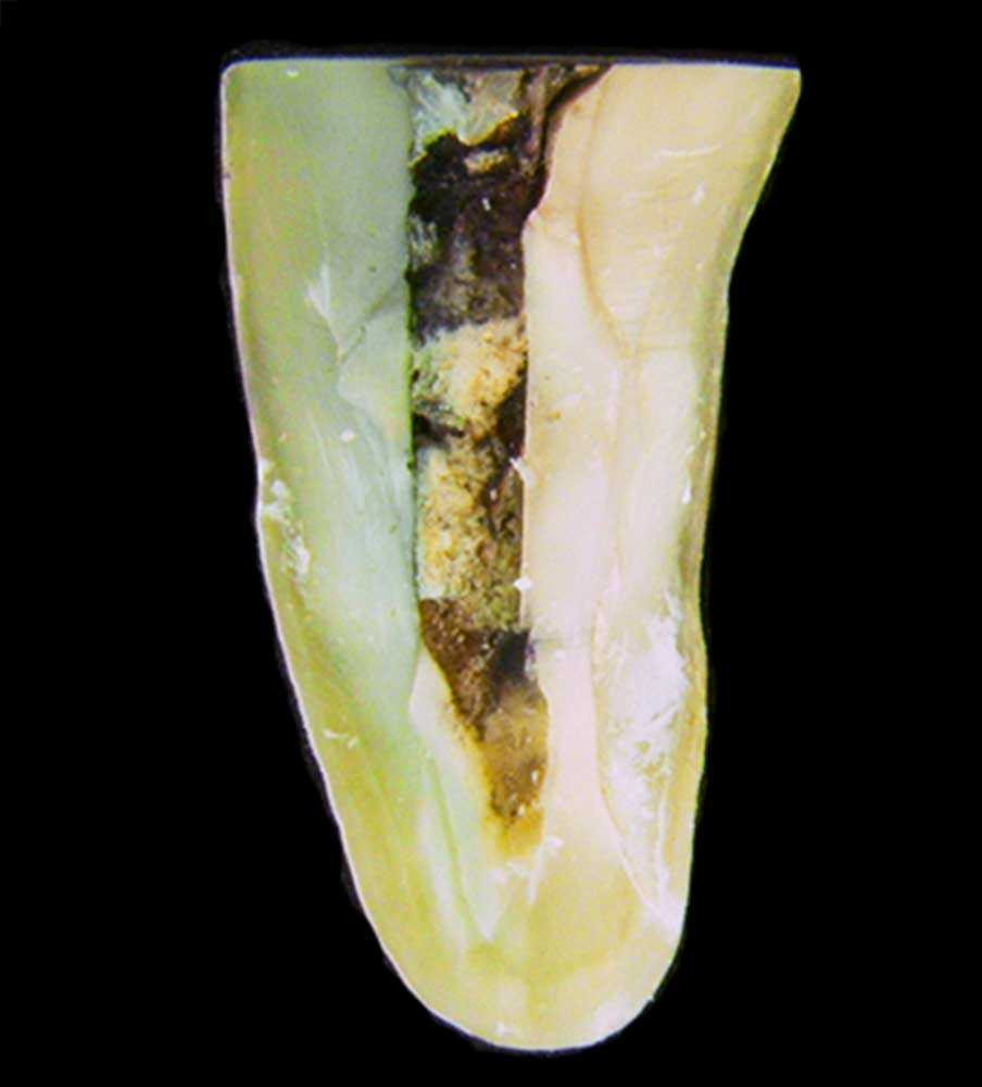 Root Canal Results Worth Talking About | GentleWave® Procedure